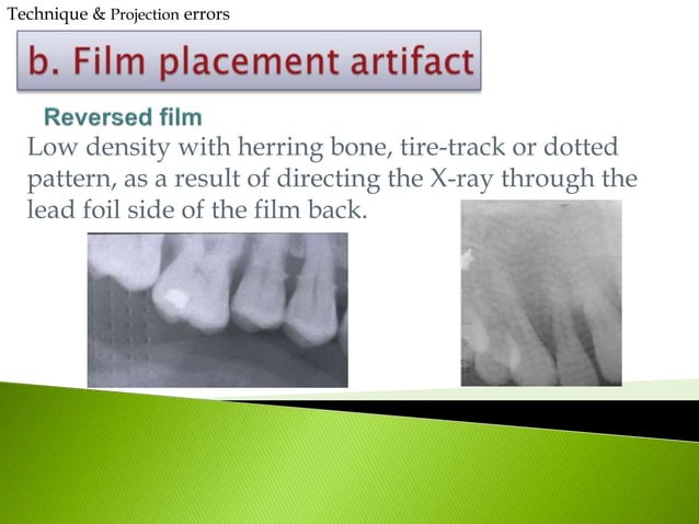 radiographic errors and artifacts | PPTX | Photo Editing Software ...
