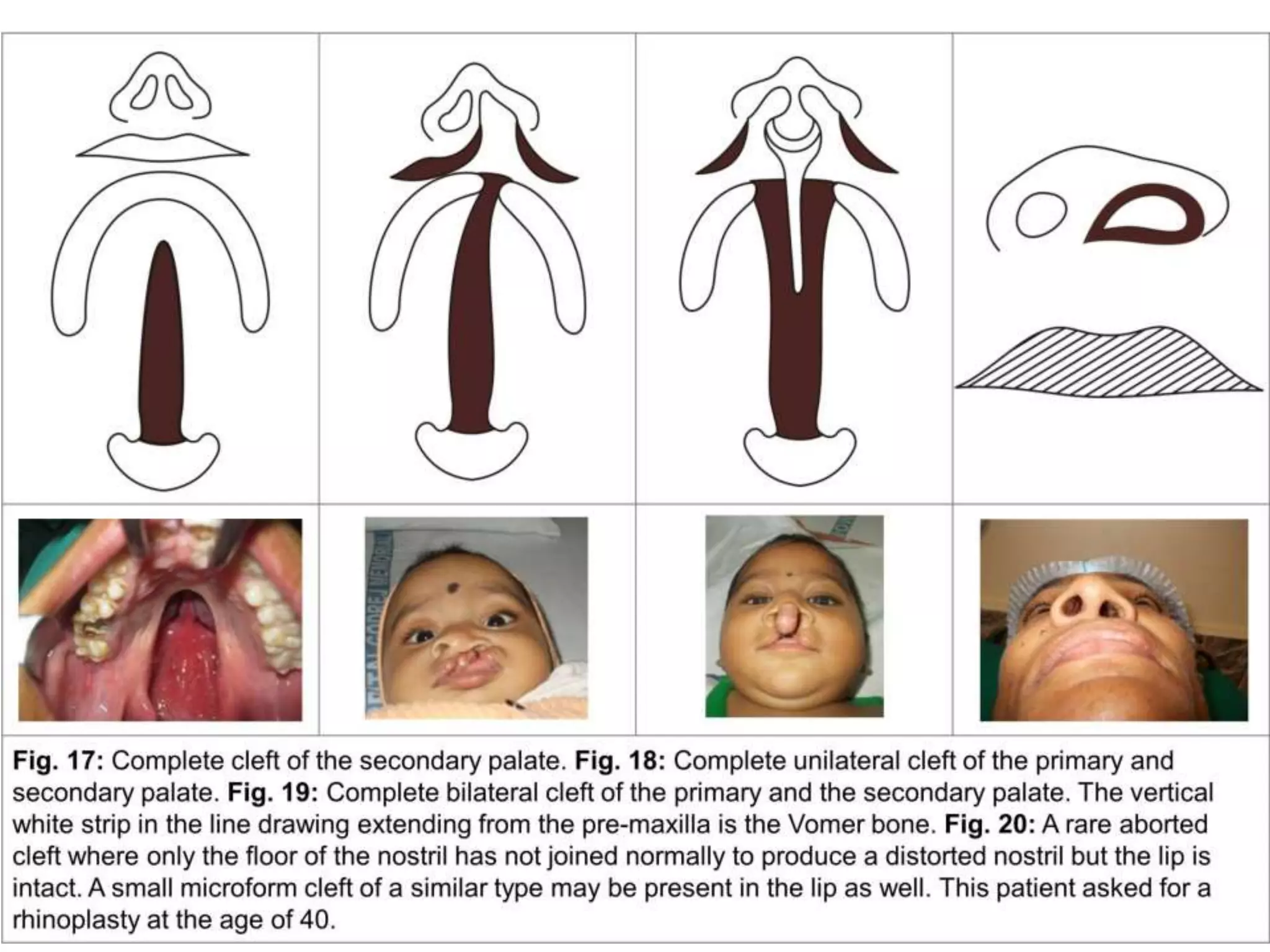 Development of Face and Palate including Anomalies of palate | PPTX