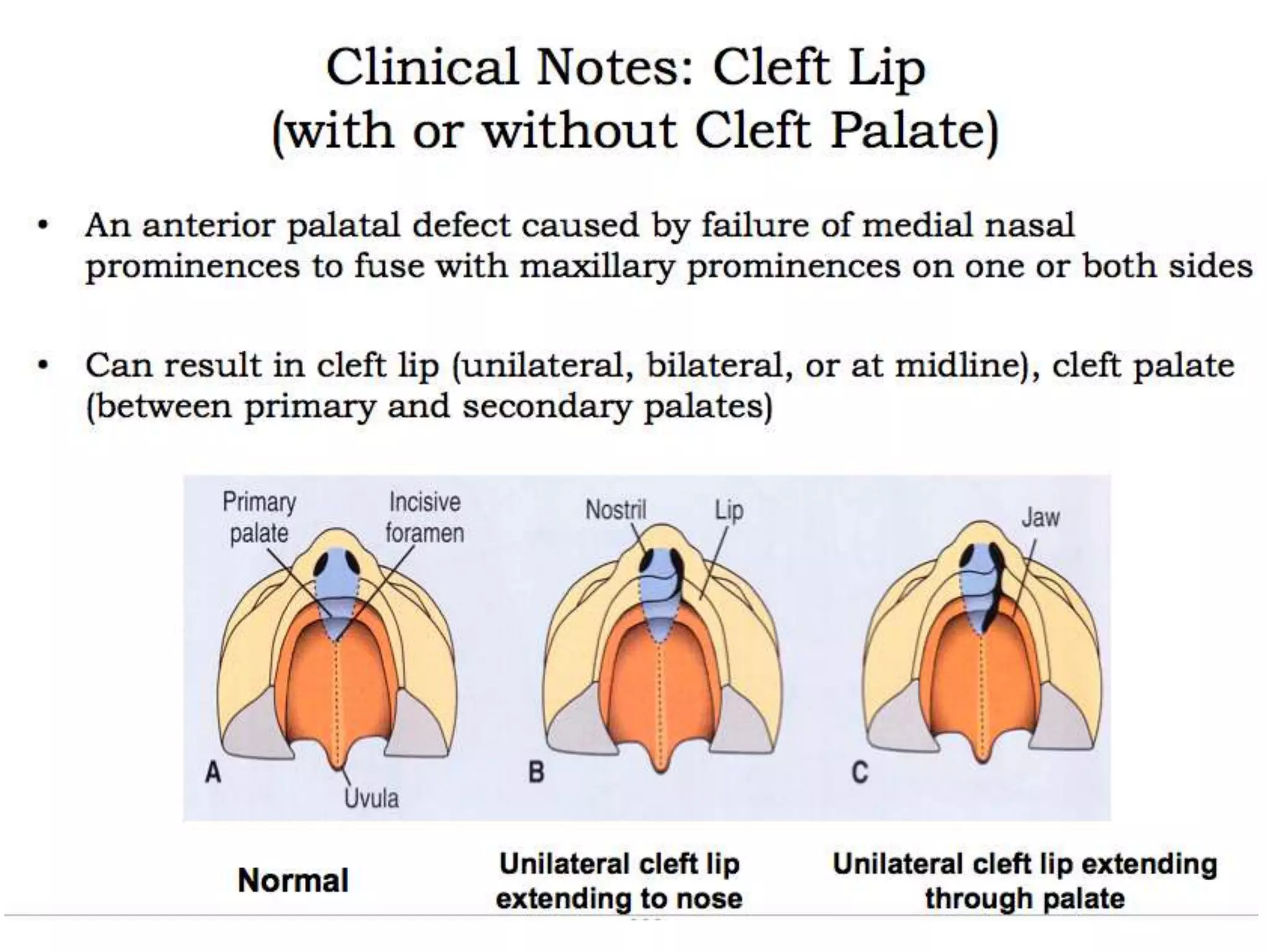 Development of Face and Palate including Anomalies of palate | PPTX