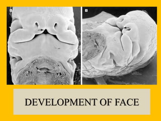Development of Face and Palate including Anomalies of palate | PPTX