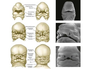 Development of Face and Palate including Anomalies of palate | PPTX