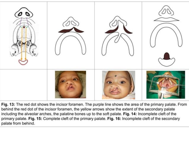 Development of Face and Palate including Anomalies of palate | PPTX