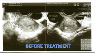 17mm Myoma (Tumor in Uterus) & 21 mm, 14mm Cysts in Left Ovary ...