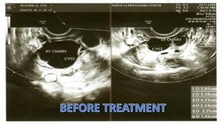 17mm Myoma (Tumor in Uterus) & 21 mm, 14mm Cysts in Left Ovary ...