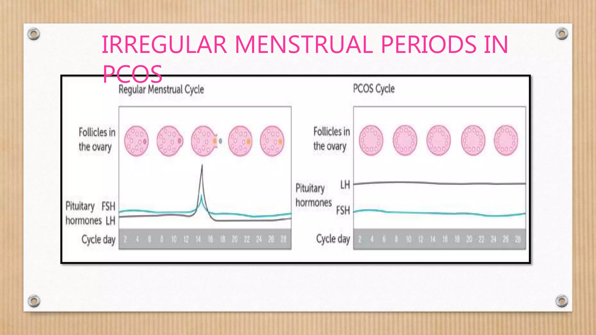 PCOS/PCOD (polycystic ovarian syndrome/polycystic ovary disease) | PPTX