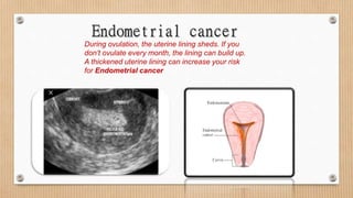 PCOS/PCOD (polycystic ovarian syndrome/polycystic ovary disease) | PPTX