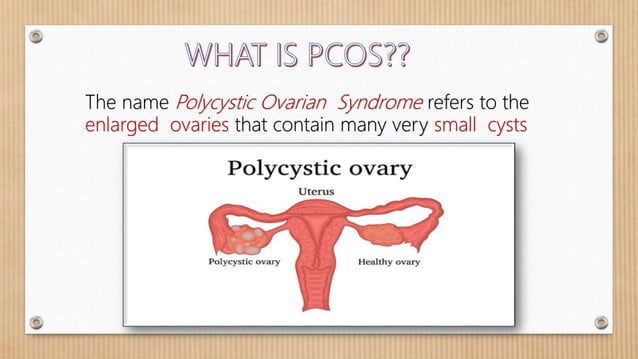PCOS/PCOD (polycystic ovarian syndrome/polycystic ovary disease) | PPTX