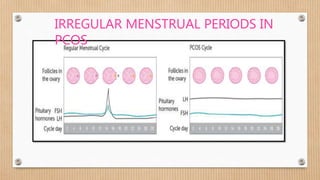 PCOS/PCOD (polycystic ovarian syndrome/polycystic ovary disease) | PPTX
