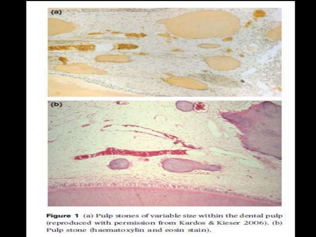MANAGEMENT OF CALCIFIED PULP CANAL | PPTX | Dental Health | Diseases ...