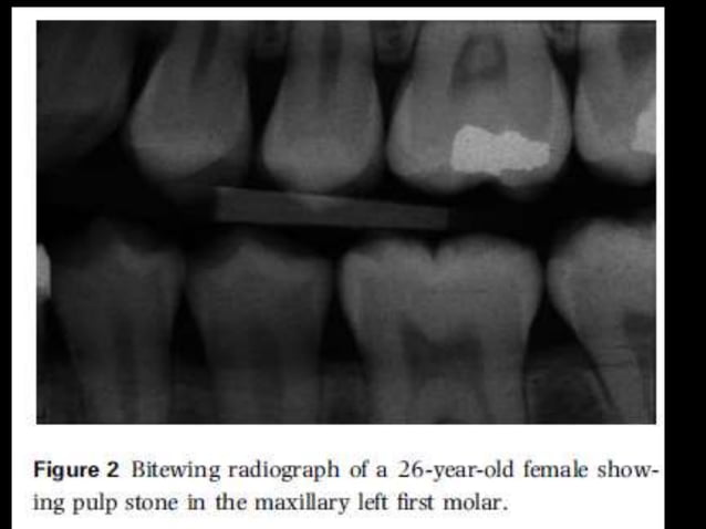 MANAGEMENT OF CALCIFIED PULP CANAL | PPTX | Dental Health | Diseases ...