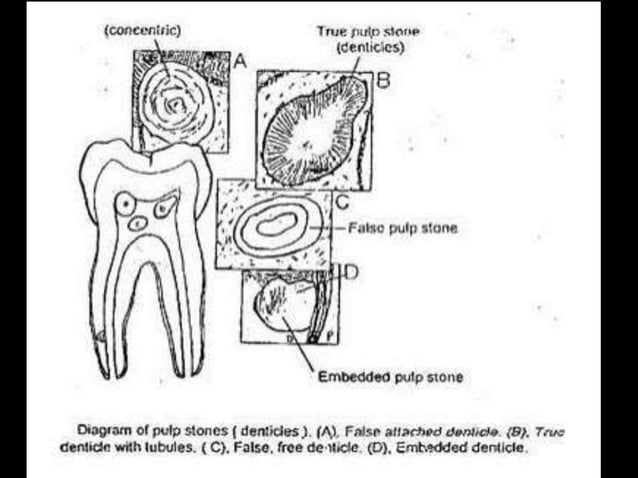 MANAGEMENT OF CALCIFIED PULP CANAL | PPTX | Dental Health | Diseases ...