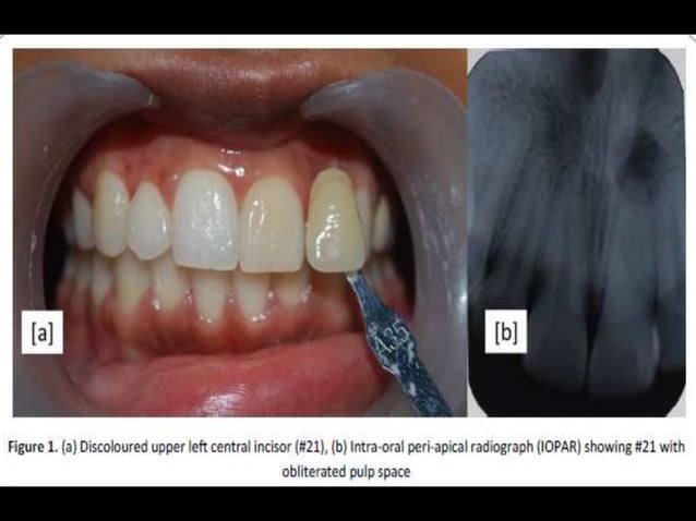 MANAGEMENT OF CALCIFIED PULP CANAL | PPTX | Dental Health | Diseases ...
