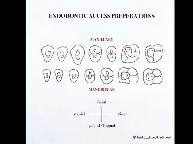 MANAGEMENT OF CALCIFIED PULP CANAL | PPTX | Dental Health | Diseases ...