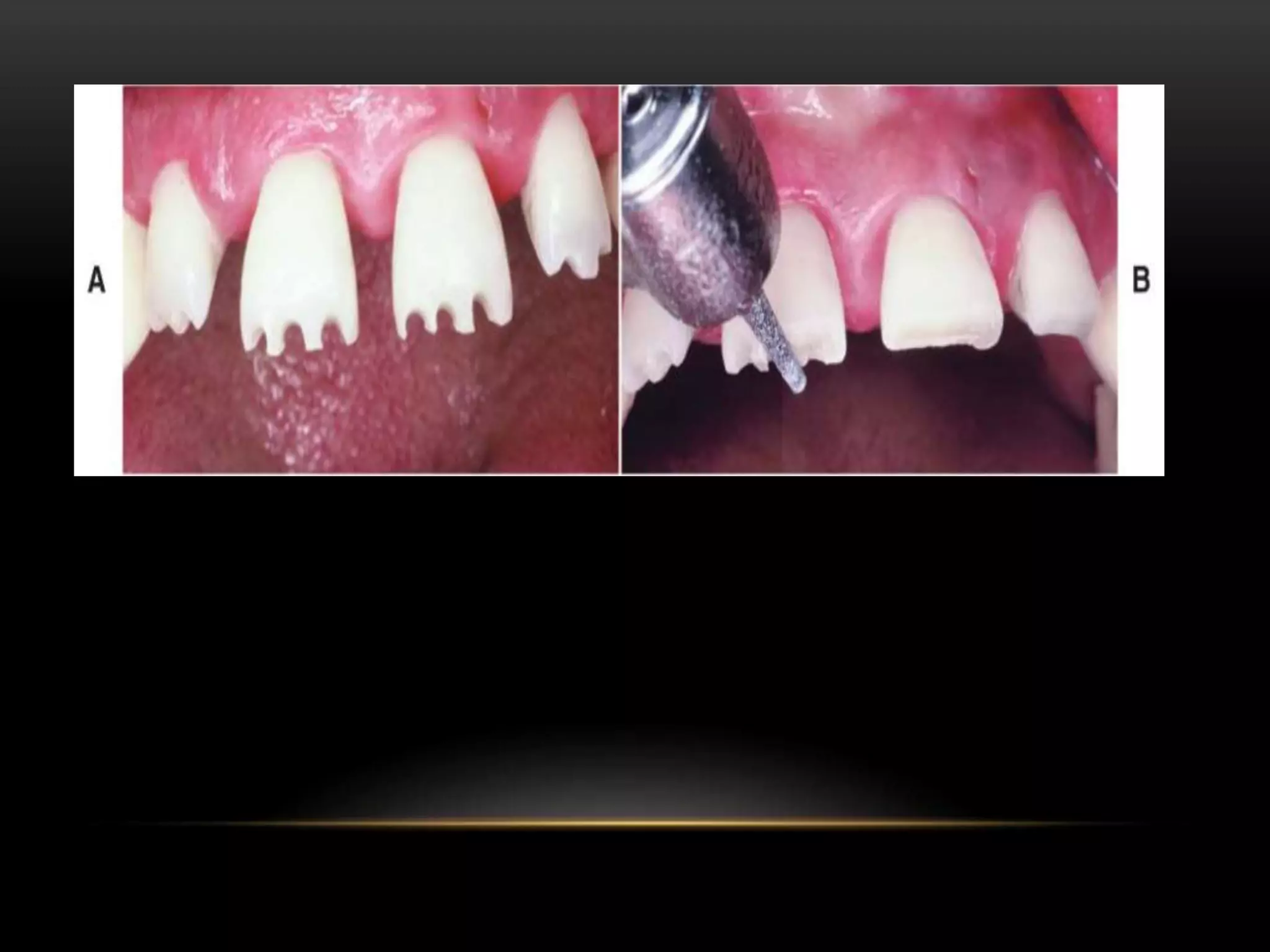 all ceramic restoration | PPTX