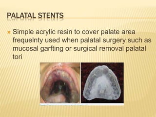 dental stents | PPTX