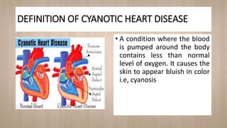Acyanotic heart disease | PPTX