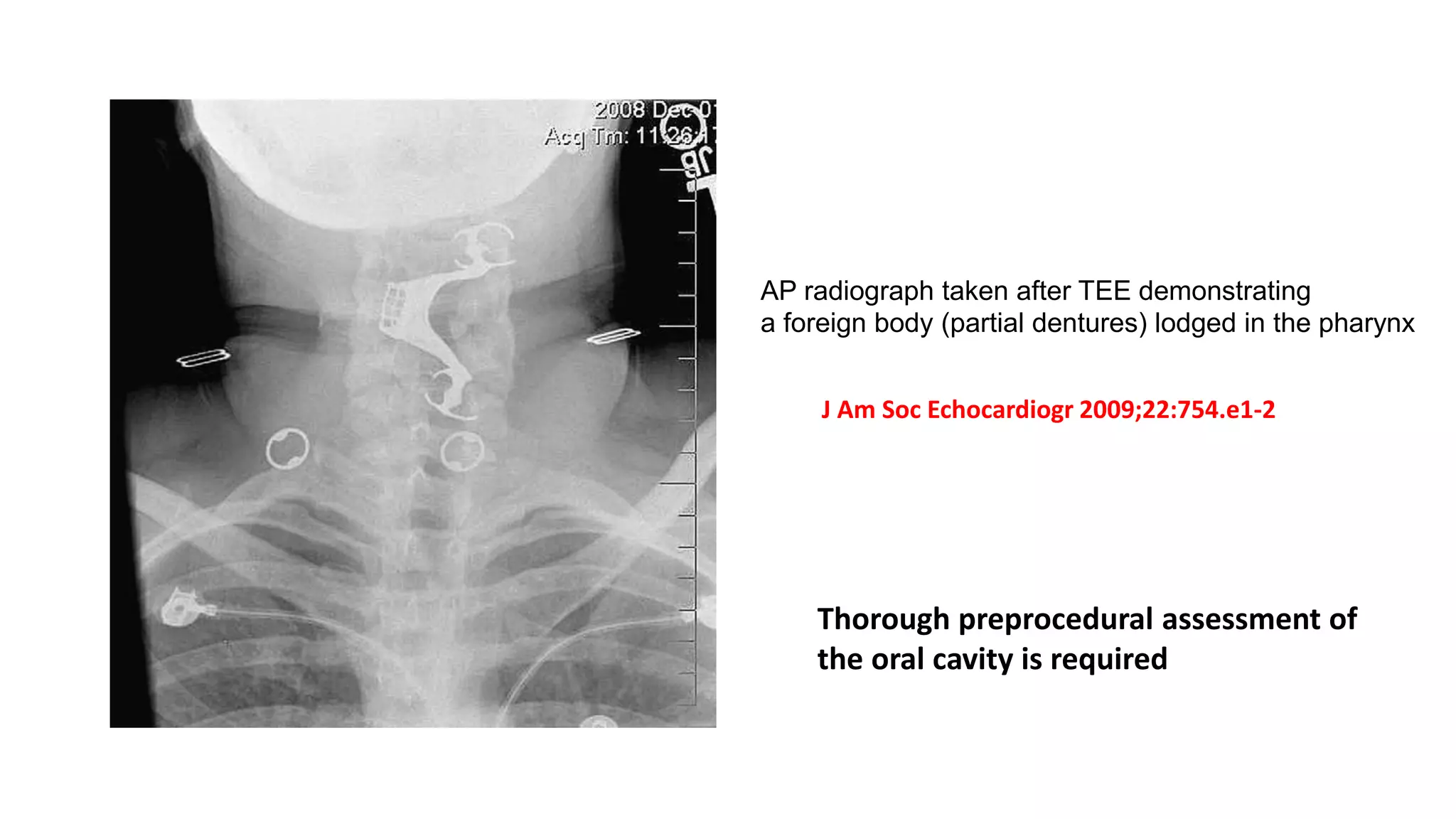 Transesophageal echocardiography complications and probe insertion ...