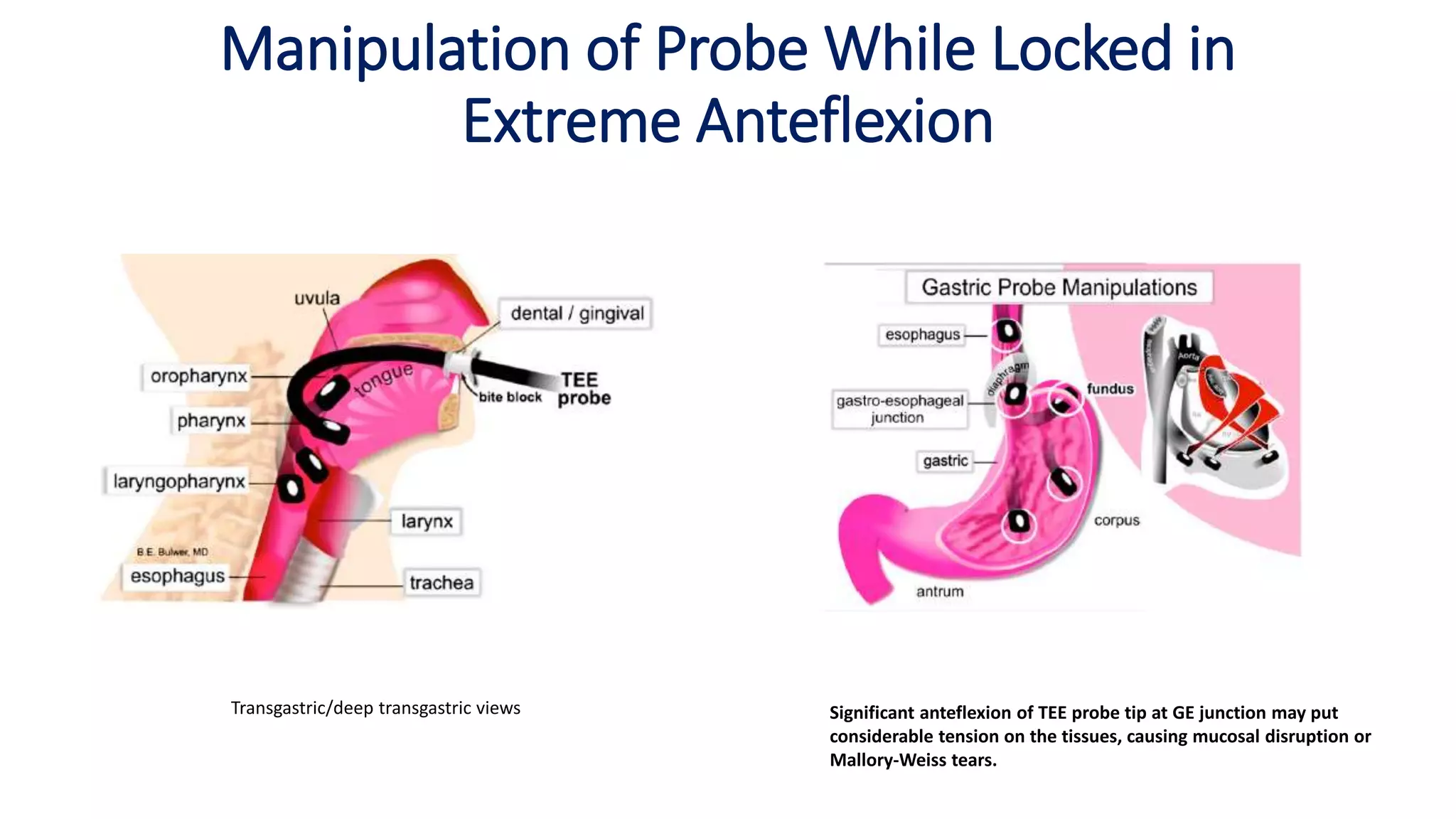 Transesophageal echocardiography complications and probe insertion ...