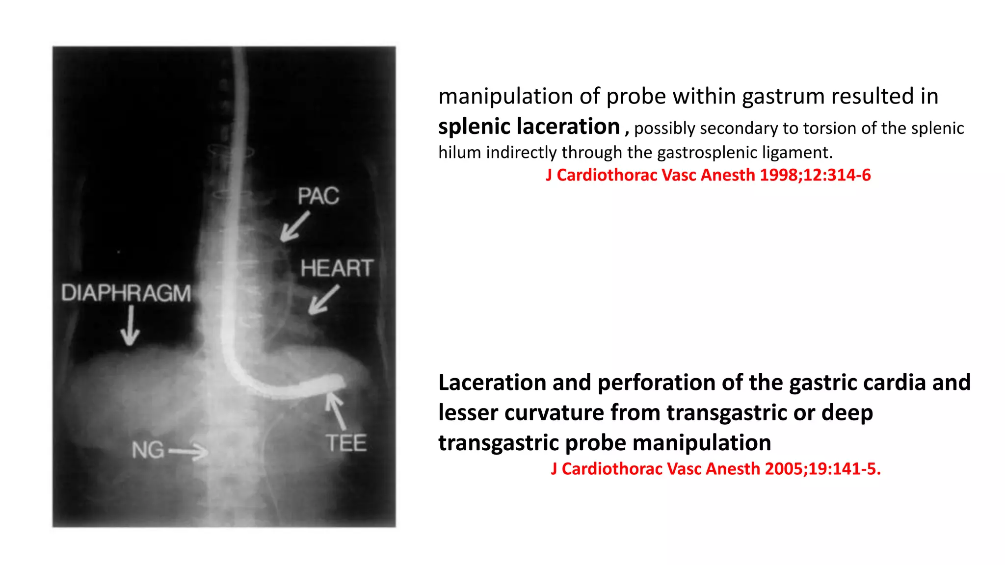 Transesophageal echocardiography complications and probe insertion ...