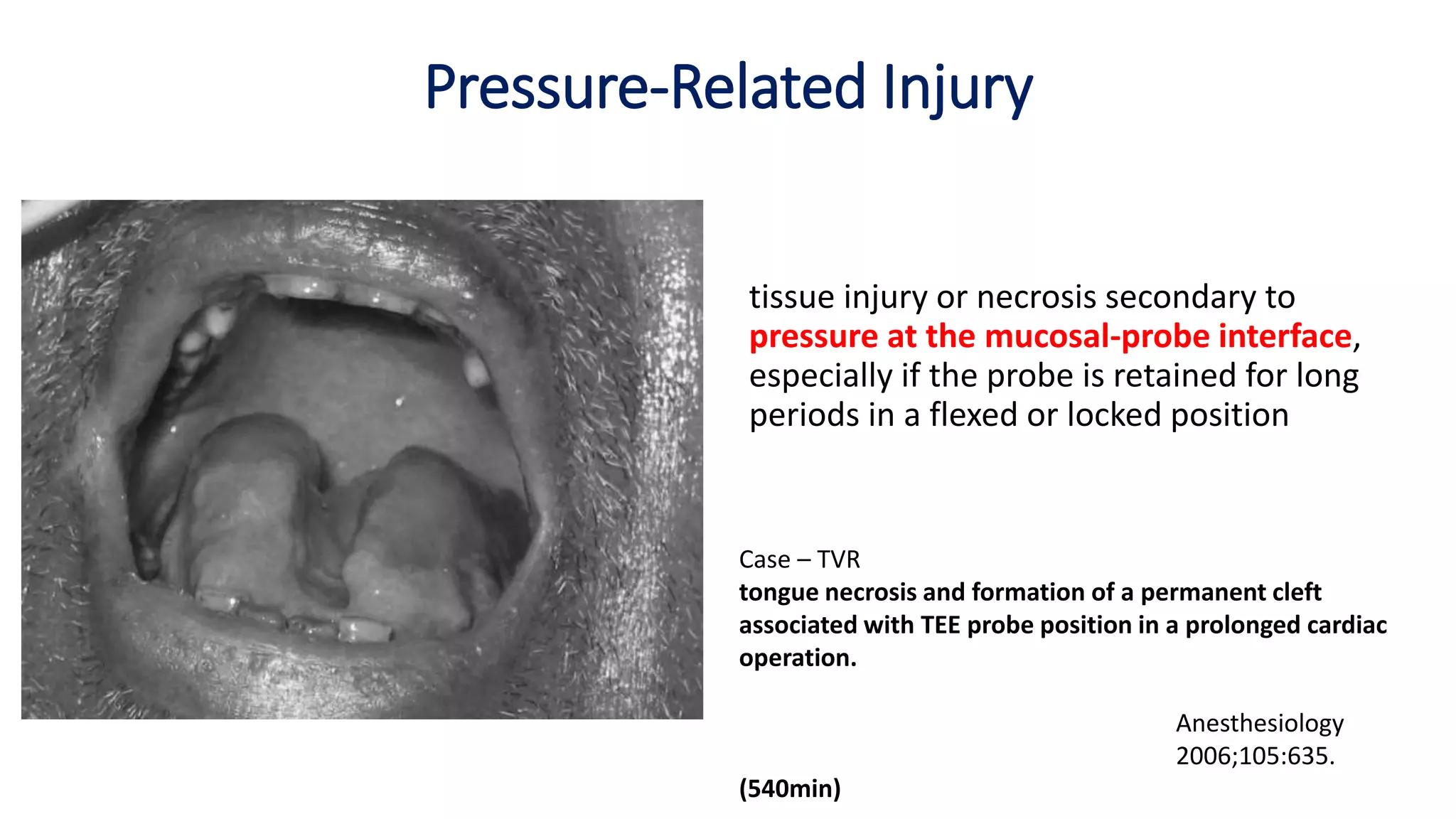Transesophageal echocardiography complications and probe insertion ...