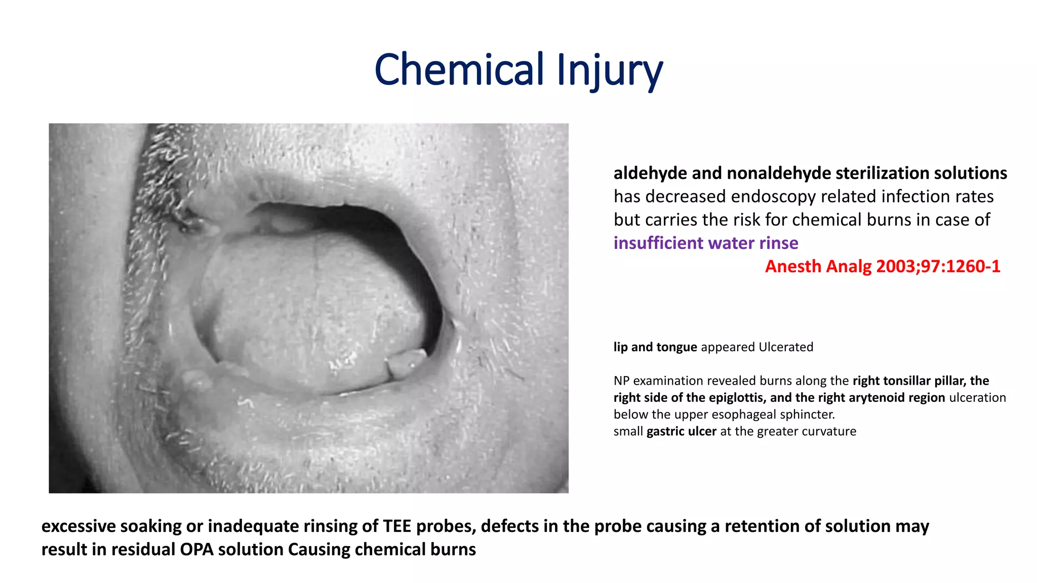 Transesophageal echocardiography complications and probe insertion ...