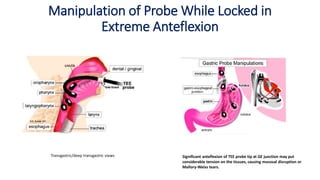Transesophageal echocardiography complications and probe insertion ...