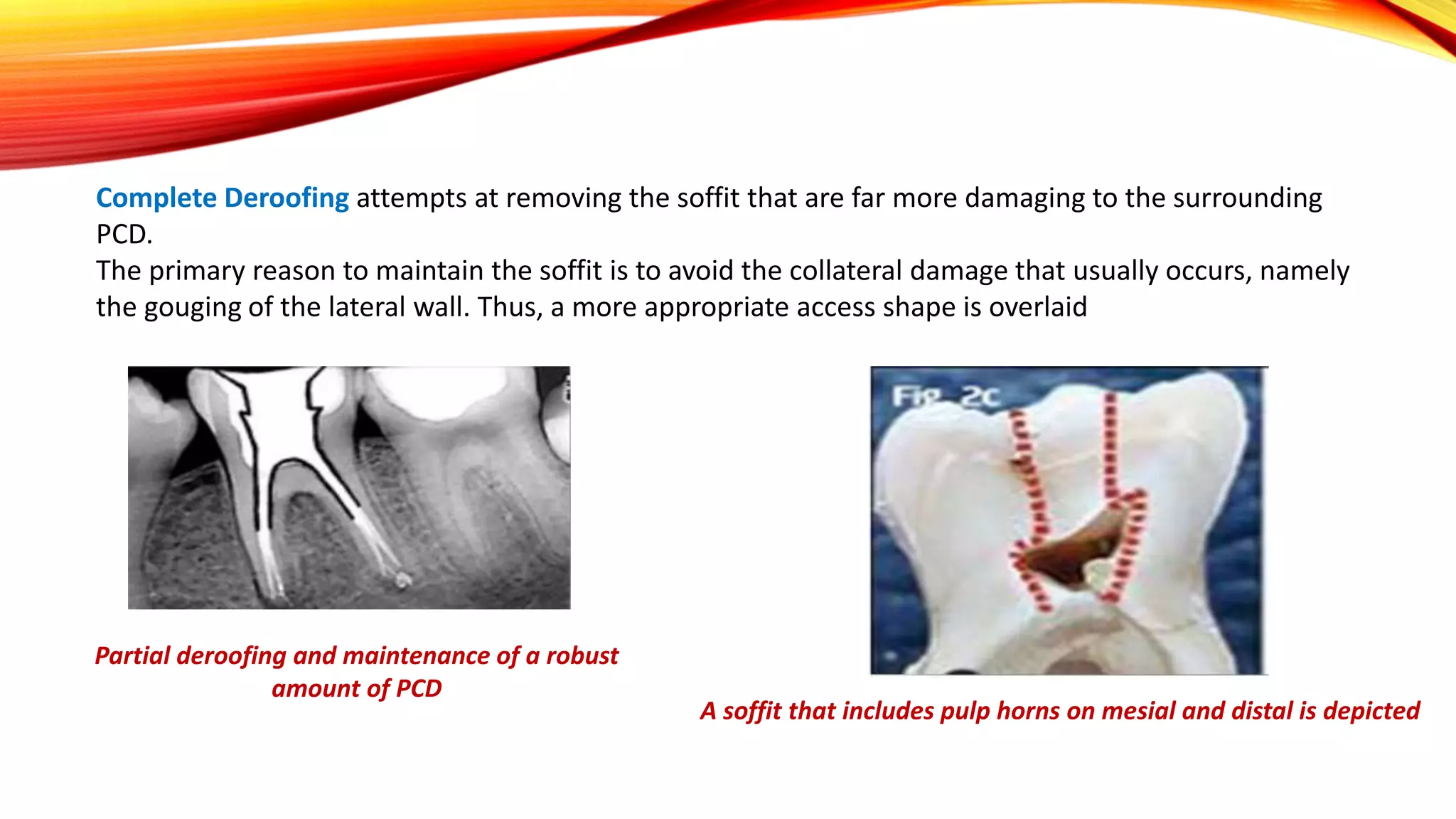 Minimal Invasive Endodontics | PPTX