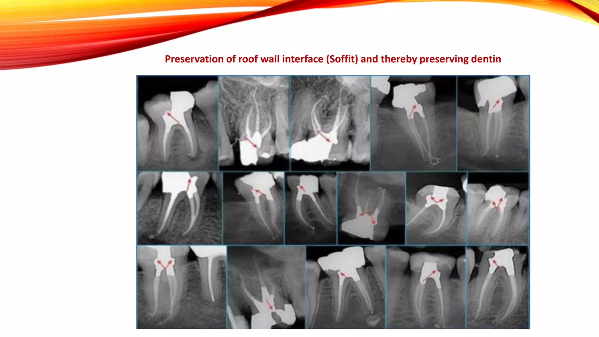Minimal Invasive Endodontics | PPTX