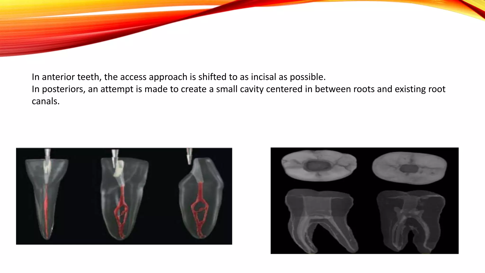 Minimal Invasive Endodontics | PPTX