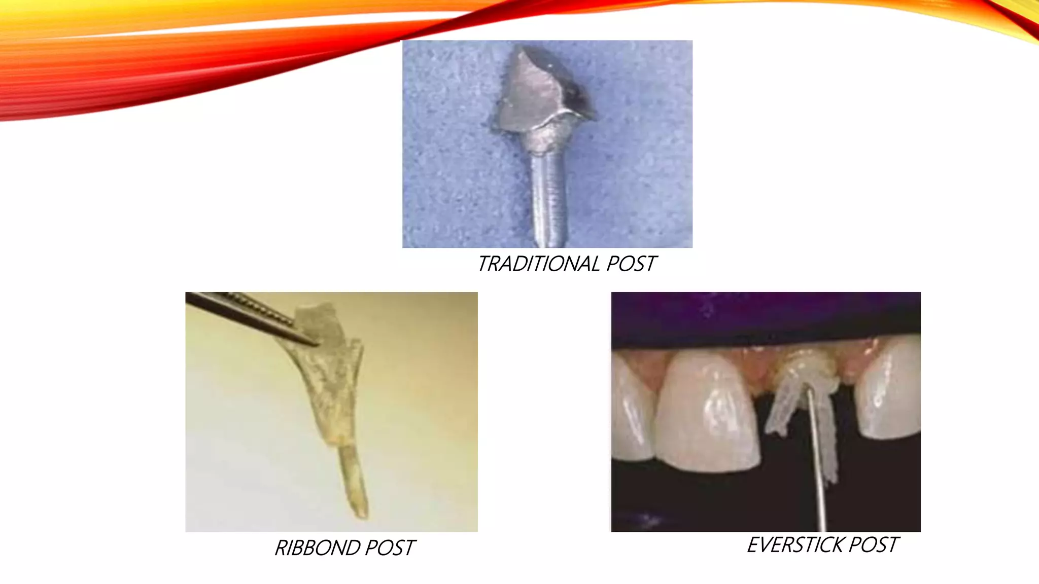 Minimal Invasive Endodontics | PPTX