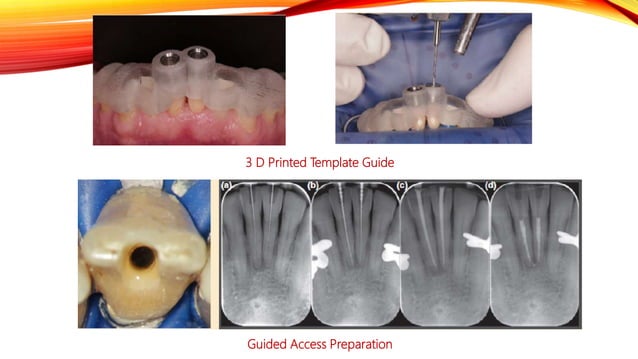 Minimal Invasive Endodontics | PPTX