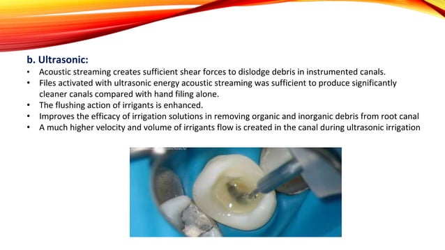 Minimal Invasive Endodontics | PPTX