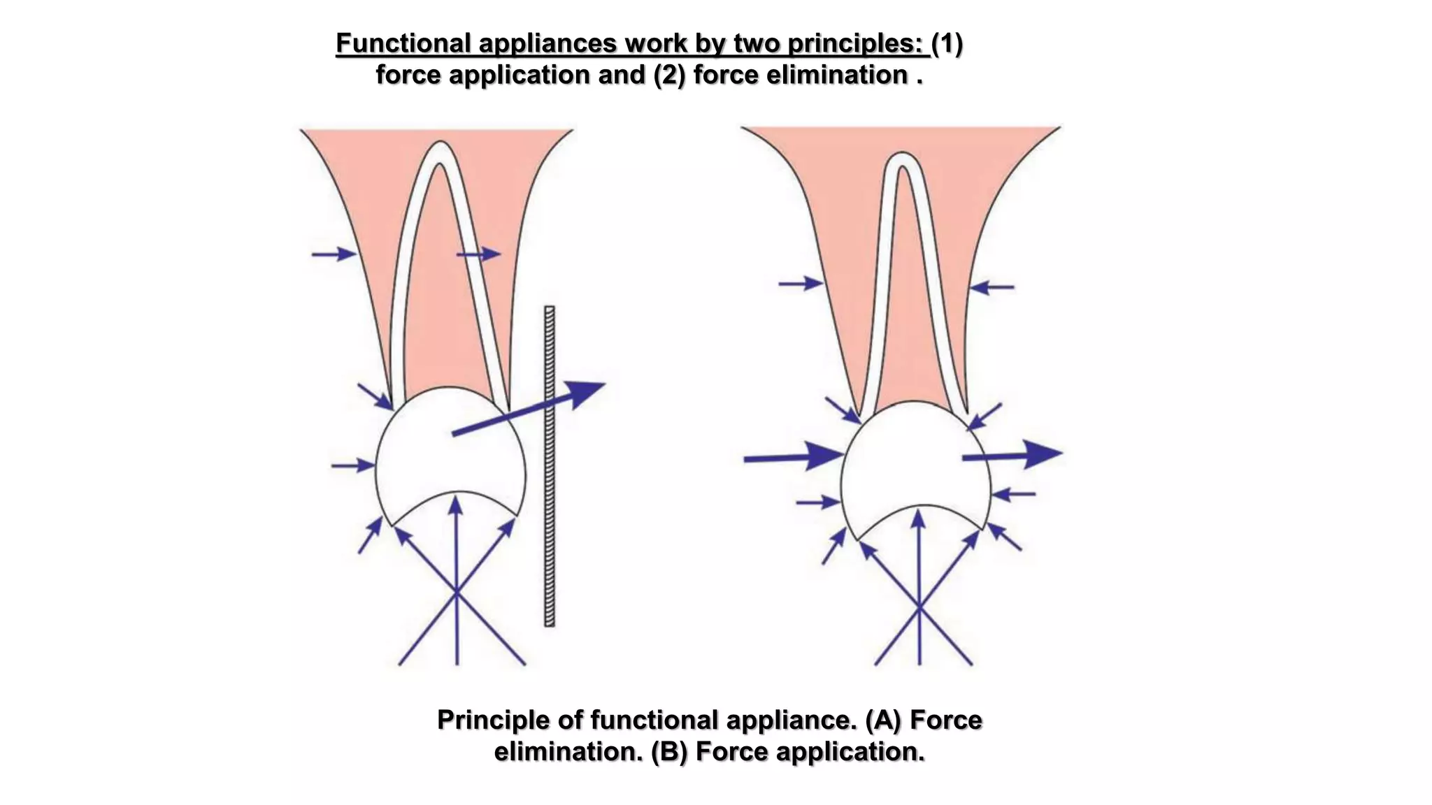removable functional appliance 1 | PPTX
