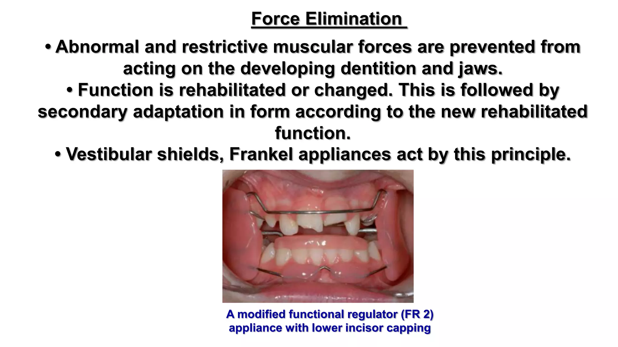 removable functional appliance 1 | PPTX