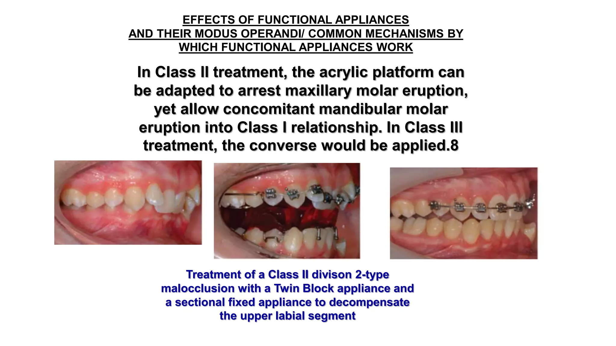 removable functional appliance 1 | PPTX
