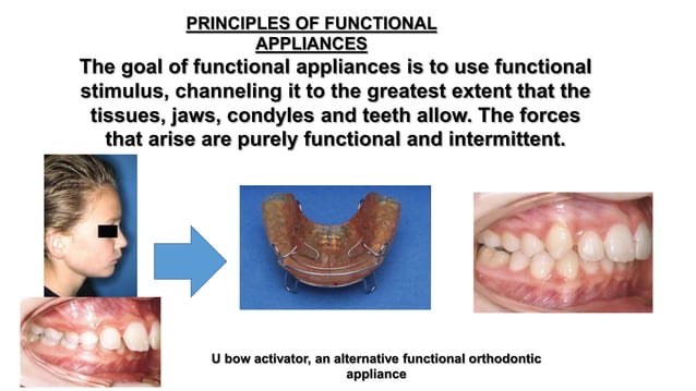 removable functional appliance 1 | PPTX