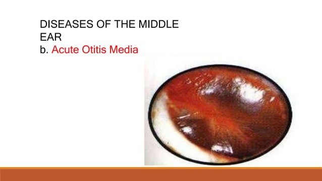 A STUDY ON COMMON EAR DISEASES | PPTX | Ear, Nose and Throat Conditions ...