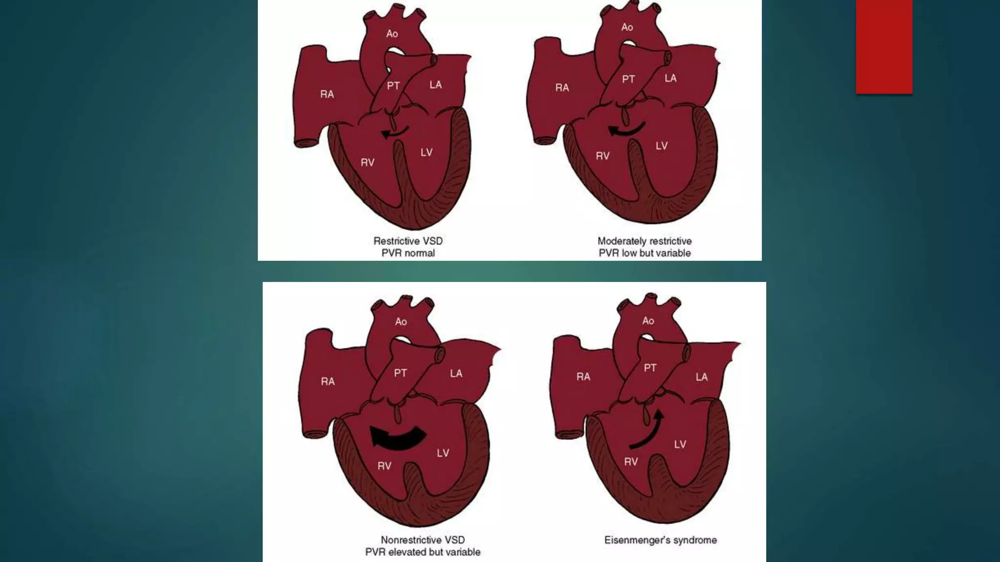 PATHOPHYSIOLOGY ,NATURAL HISTORY OF VSD | PPTX