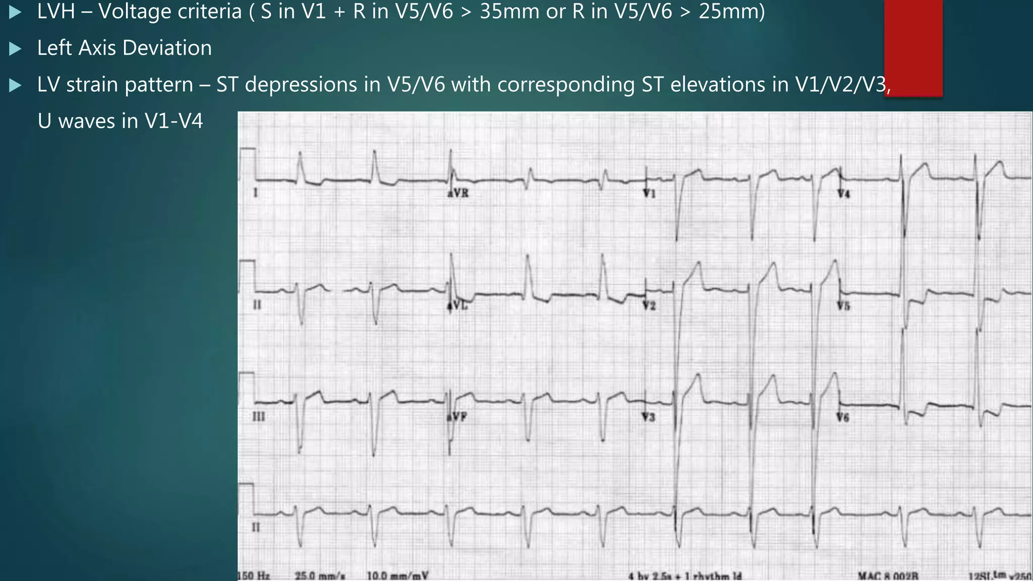PATHOPHYSIOLOGY ,NATURAL HISTORY OF VSD | PPTX