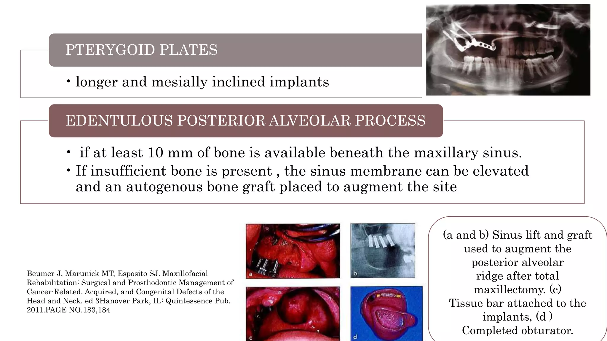 PROSTHODONTIC MANAGEMENT OF MAXILLECTOMY/ OBTURATORS PART 2 | PPTX