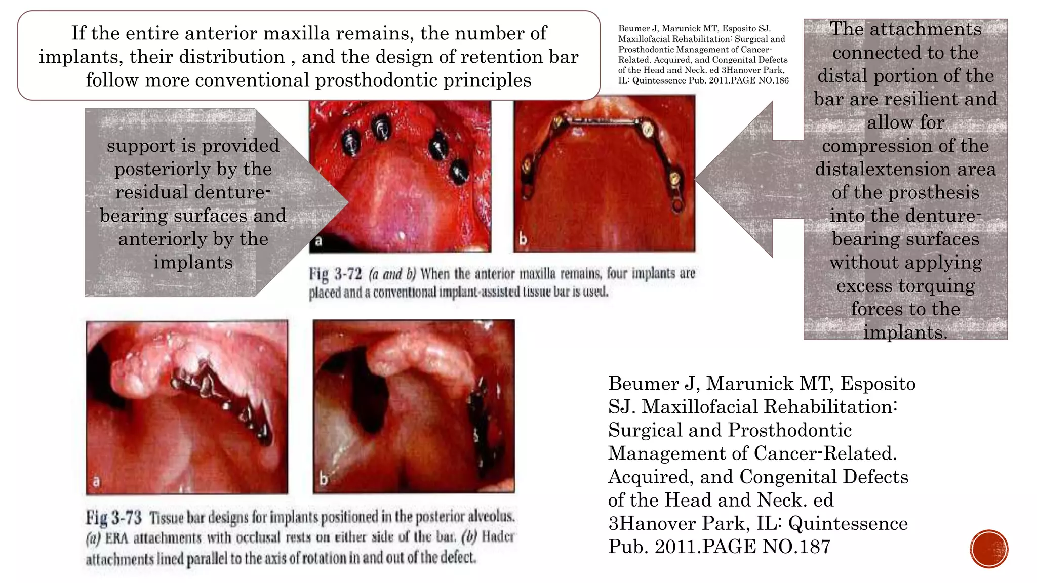 PROSTHODONTIC MANAGEMENT OF MAXILLECTOMY/ OBTURATORS PART 2 | PPTX