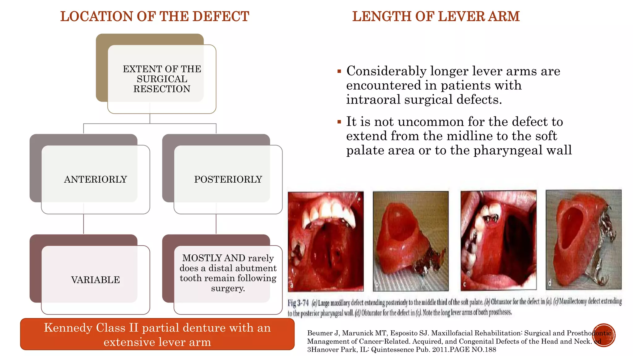 PROSTHODONTIC MANAGEMENT OF MAXILLECTOMY/ OBTURATORS PART 2 | PPTX
