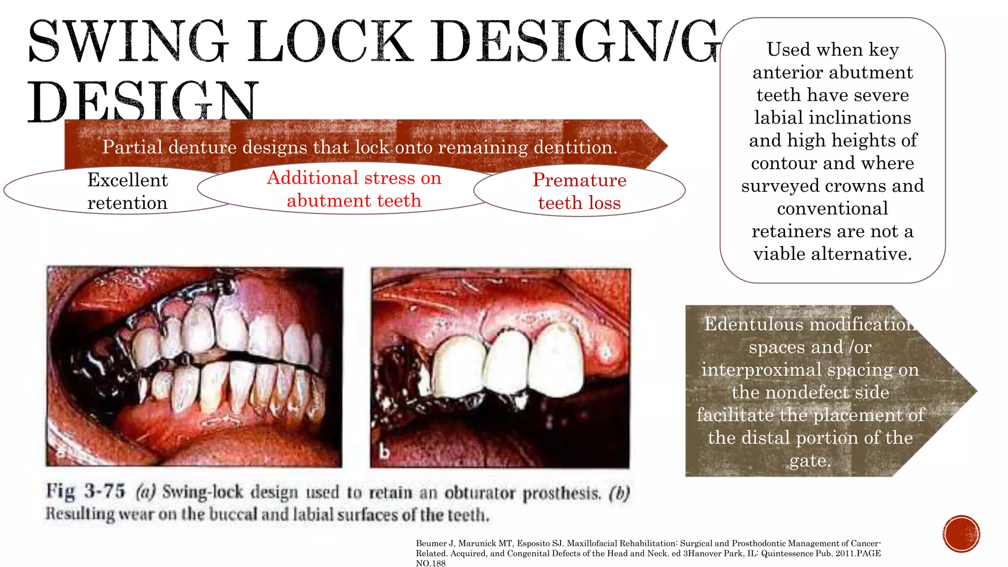 PROSTHODONTIC MANAGEMENT OF MAXILLECTOMY/ OBTURATORS PART 2 | PPTX