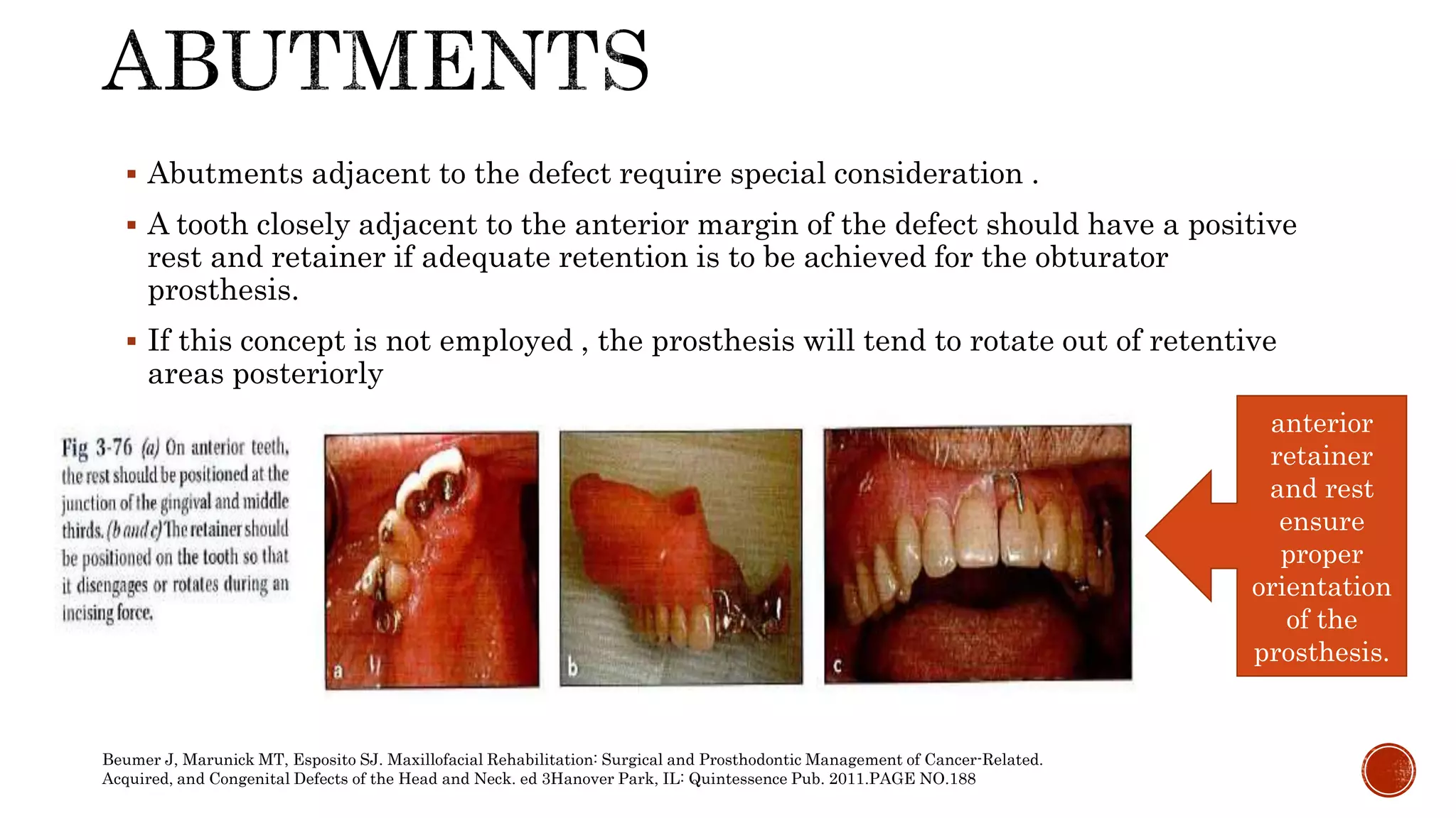 PROSTHODONTIC MANAGEMENT OF MAXILLECTOMY/ OBTURATORS PART 2 | PPTX