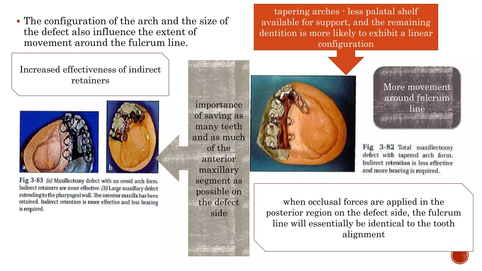 PROSTHODONTIC MANAGEMENT OF MAXILLECTOMY/ OBTURATORS PART 2 | PPTX