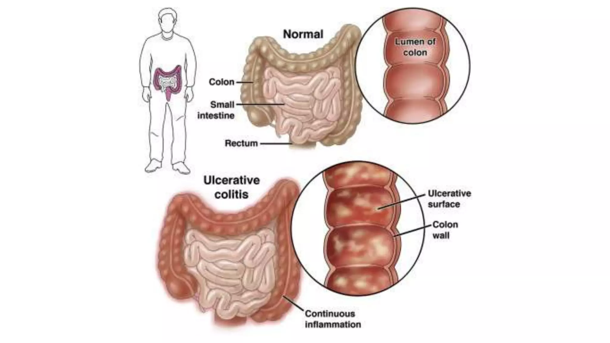 Ulcerative Colitis (UC) | PPTX