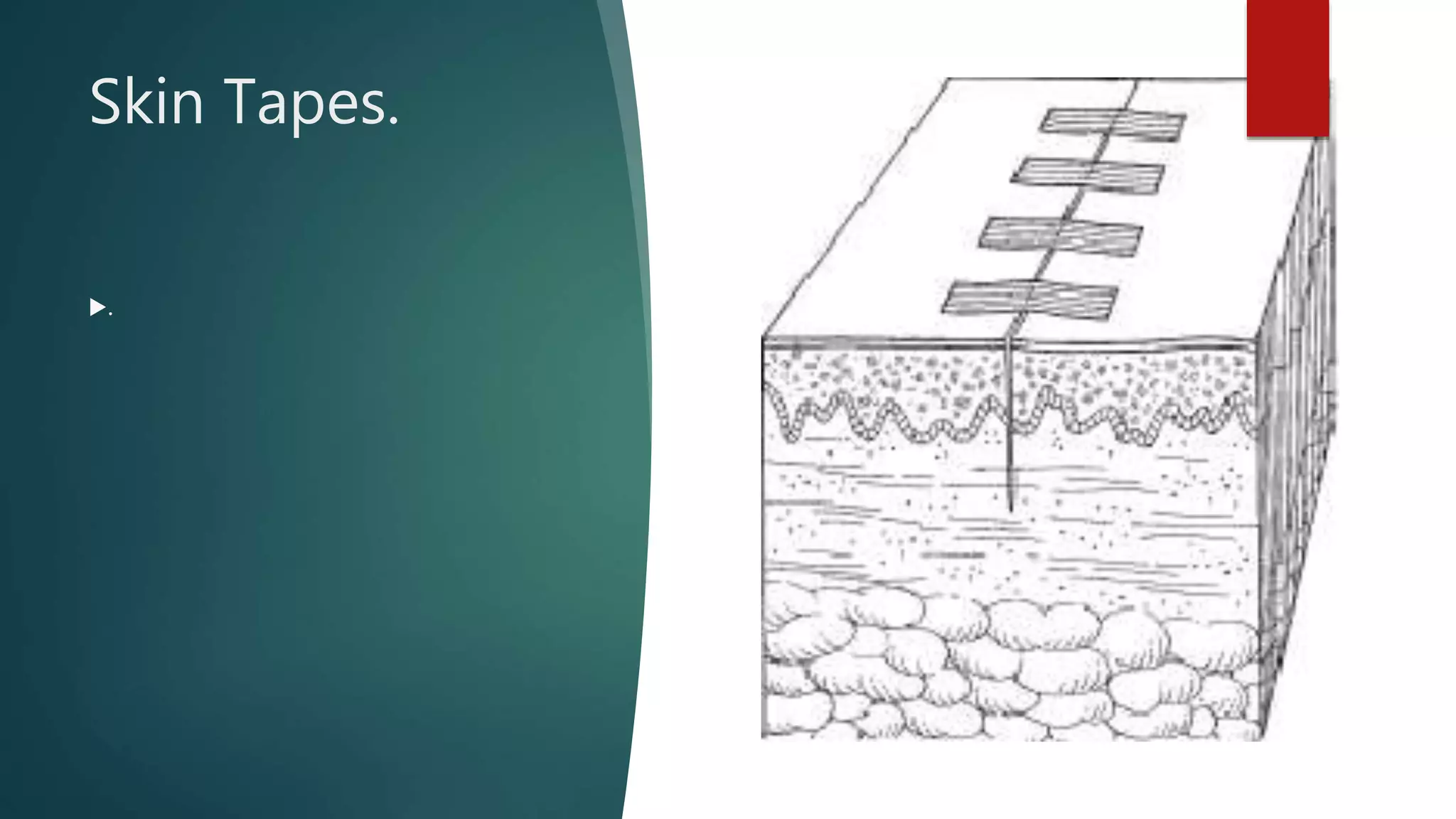 Suture techniques, Z-plasty | PPTX