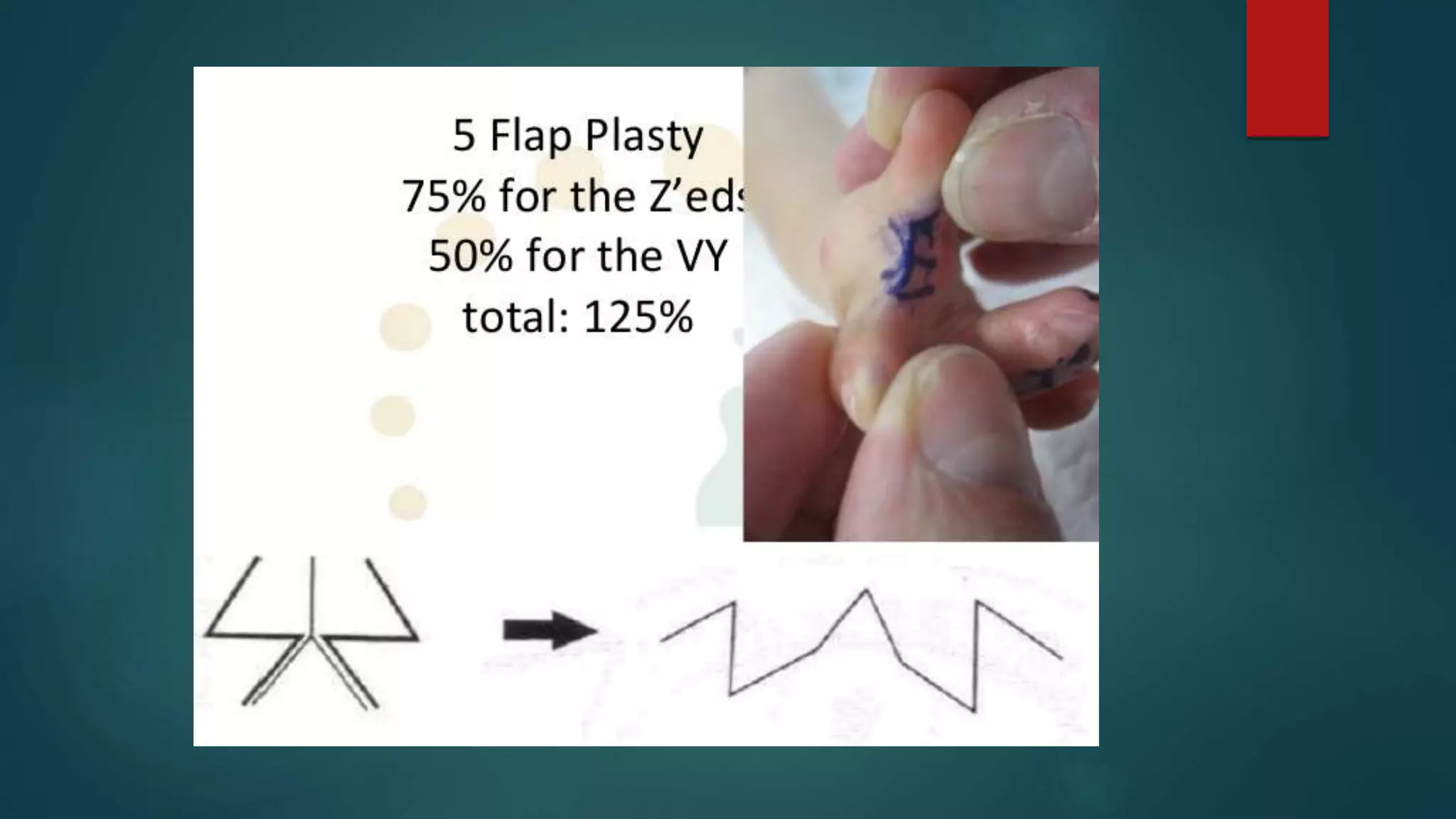 Suture techniques, Z-plasty | PPTX