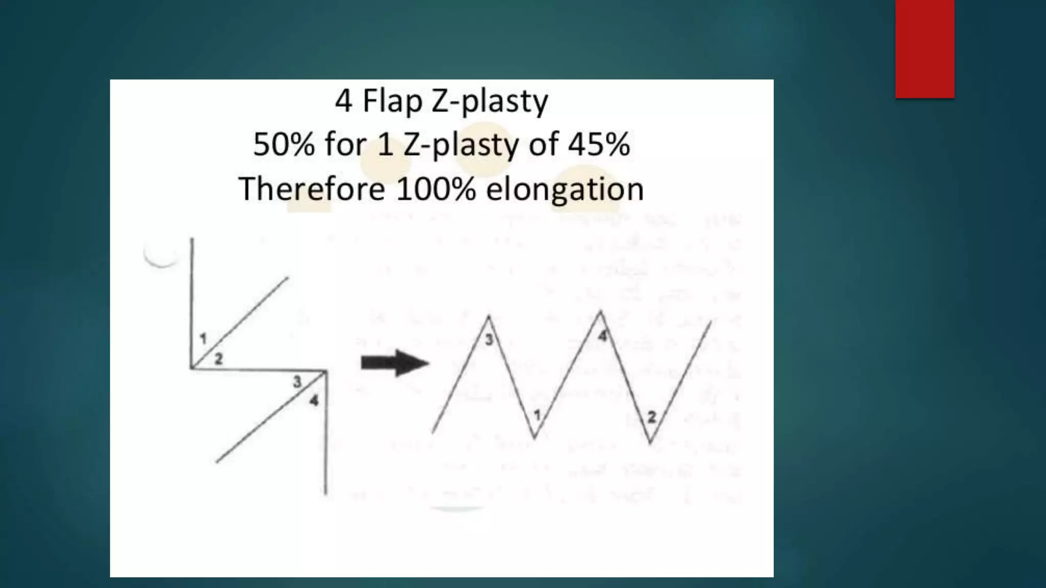 Suture techniques, Z-plasty | PPTX