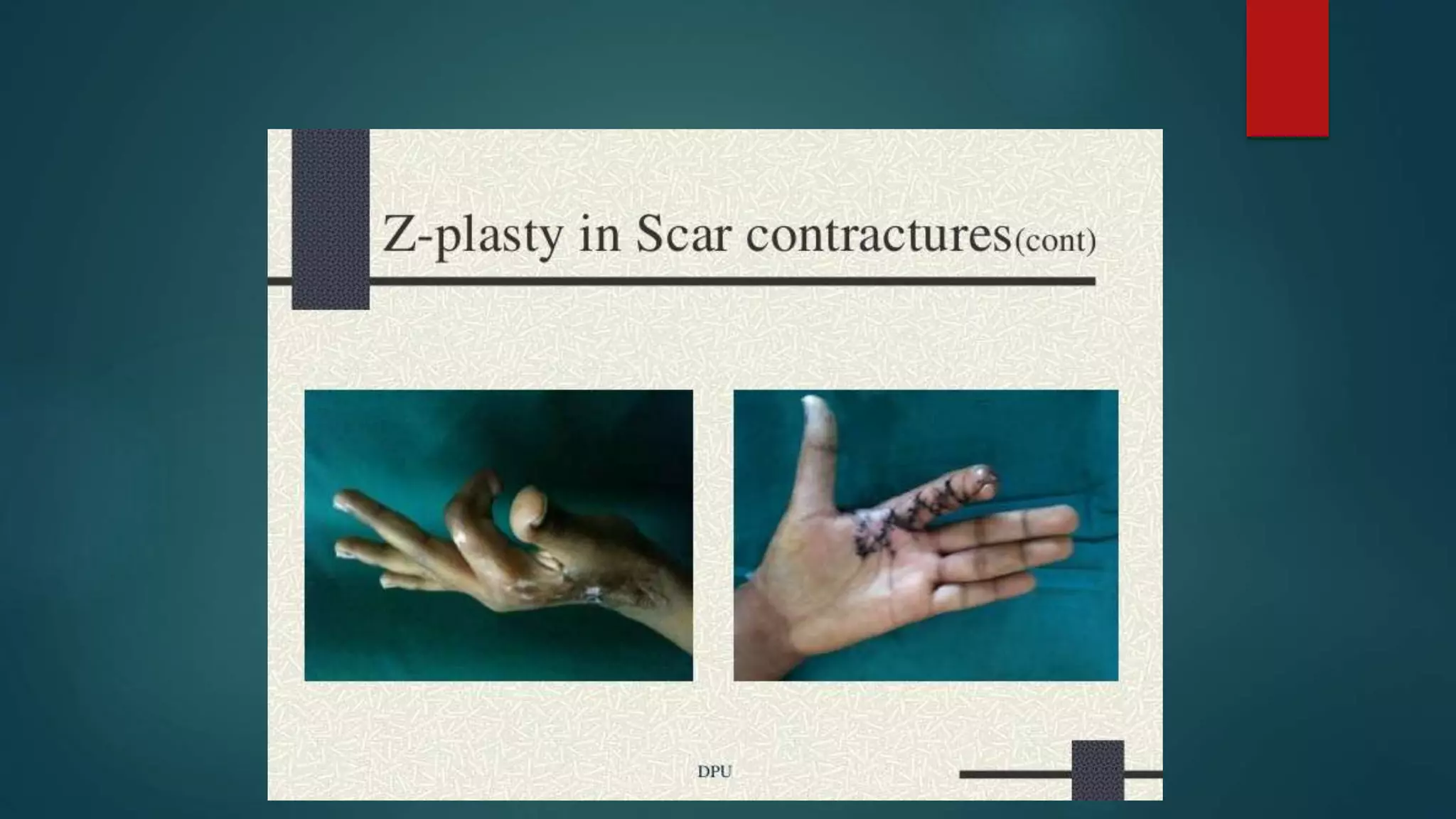 Suture techniques, Z-plasty | PPTX